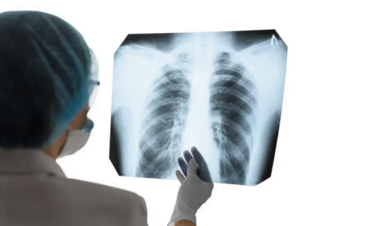 Tanda Edema Paru: Pengertian, Penyebab dan Cara Mengatasinya Dengan ...