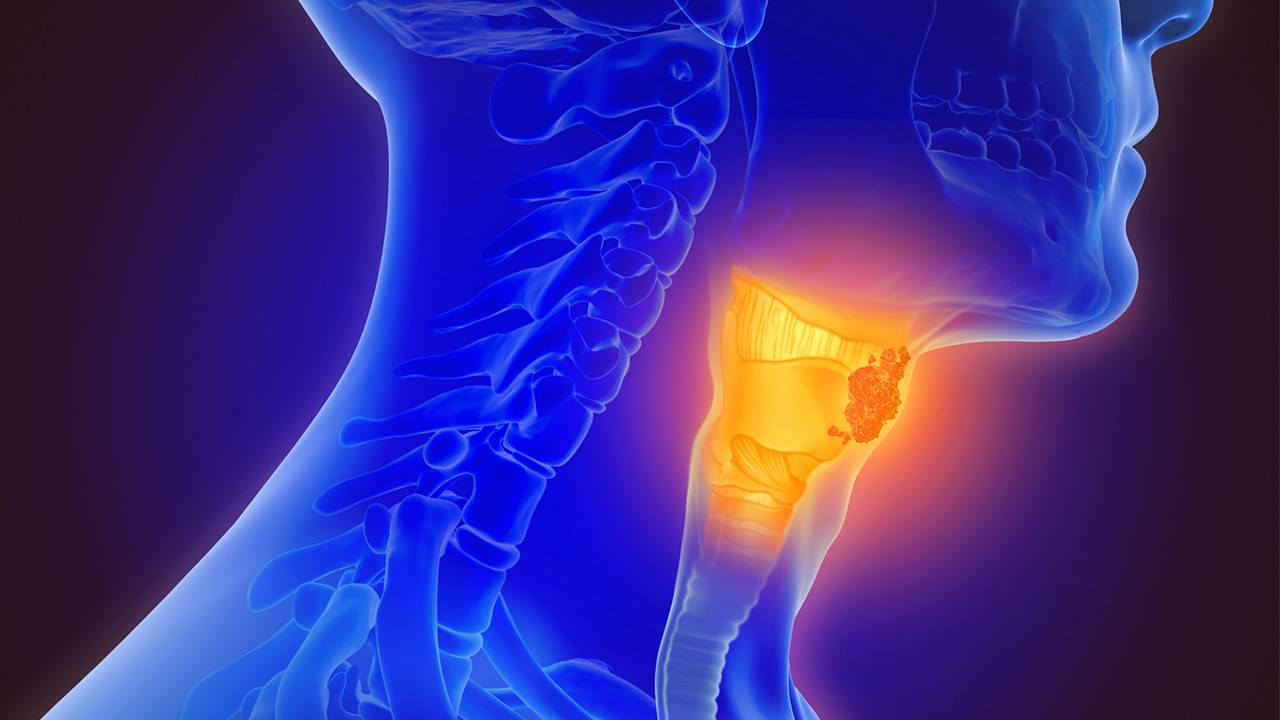 Faringitis Akut: Penyebab, Gejala, Tanda-Tanda dan Pencegahan - IndoTimes