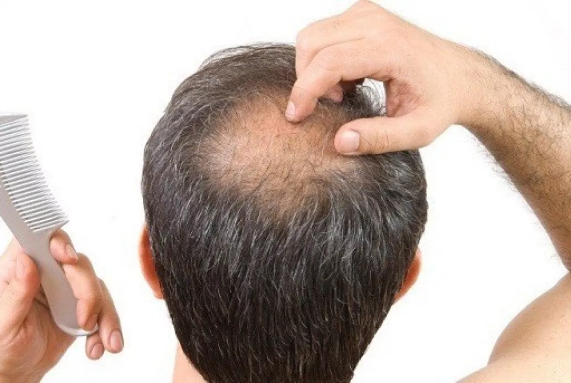 9 Rekomendasi Model Rambut Pria Botak Keren yang Wajib Dicoba